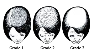 womens-hair-loss-scale - Transitions Hair Solutions Moline Davenport ...